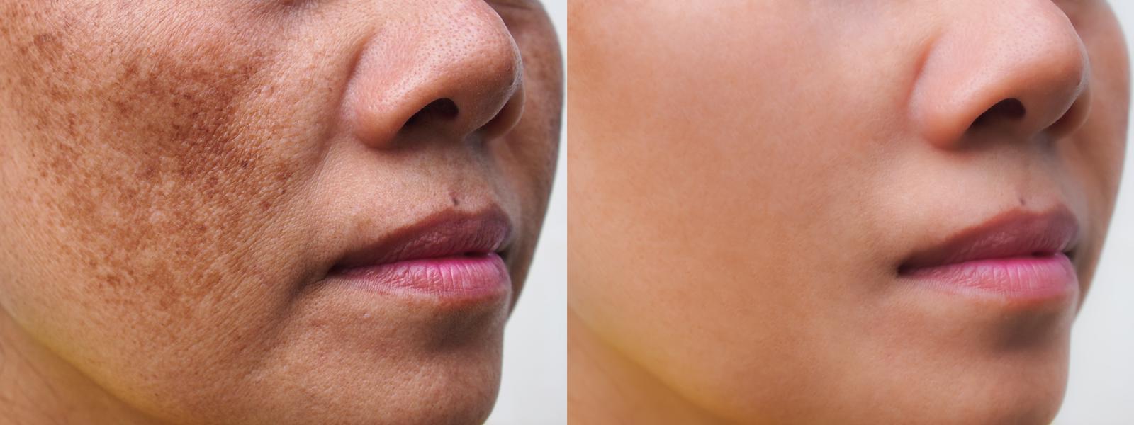Cosmelan Depigmentation Peel - House of Aesthetics London
