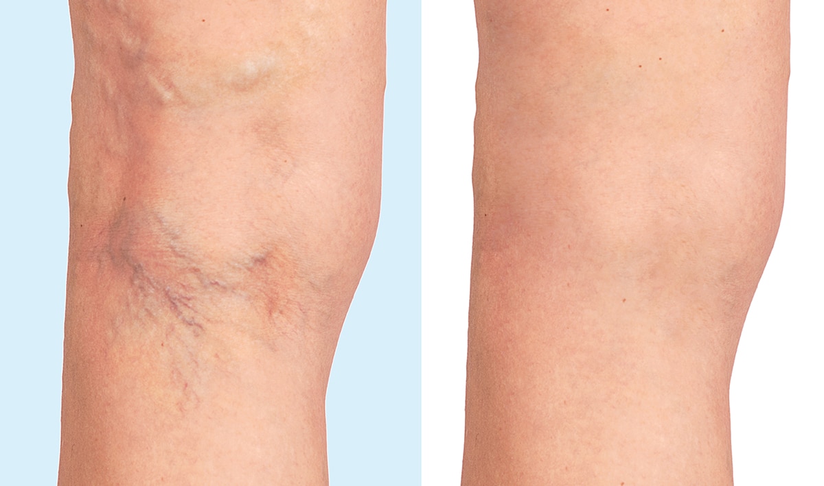 Laser Thread Vein Removal Bromley - House of Aesthetics London