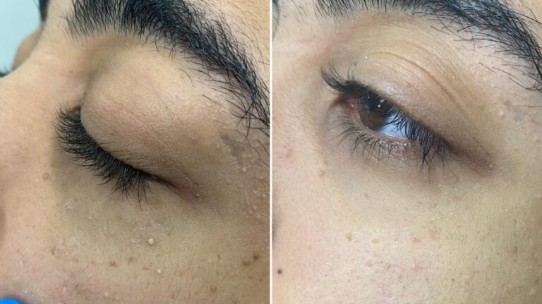 Electrolysis Lesion & Hair Removal Bromley | Permanent Treatments